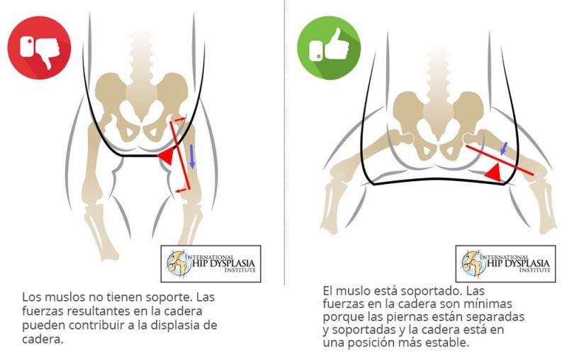 Displasia de Cadera - Orthotherapy Condesa